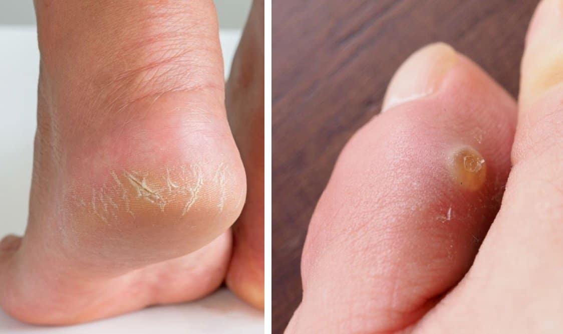 Hard Corn Removal Surgery