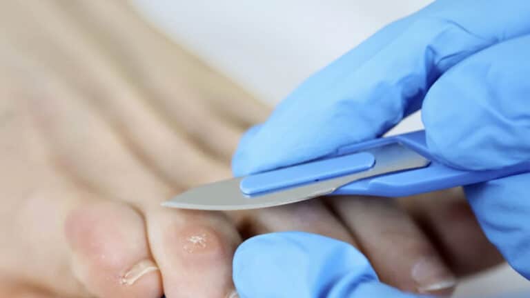 Surgery Corn Removal - Corn Removal Surgery