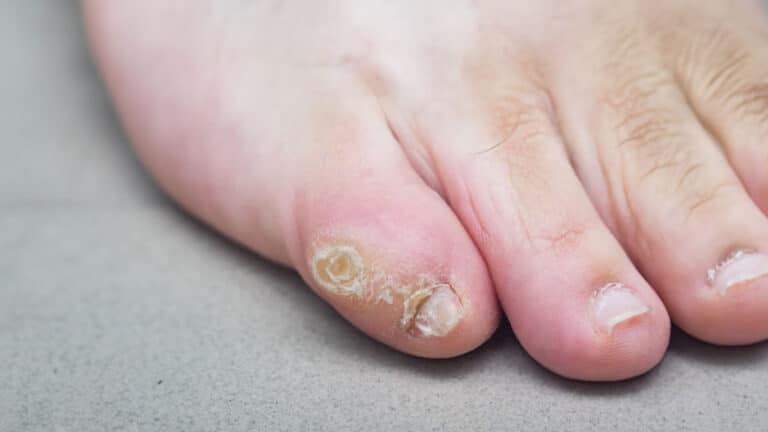 Surgery Corn Removal - Corn Removal Surgery