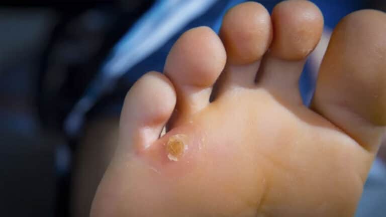 Surgery Corn Removal - Corn Removal Surgery