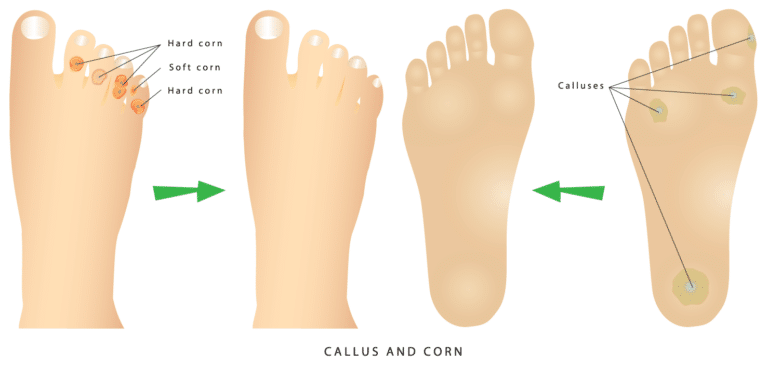 Corn Surgery Recovery: Get Back on Your Feet in No Time!